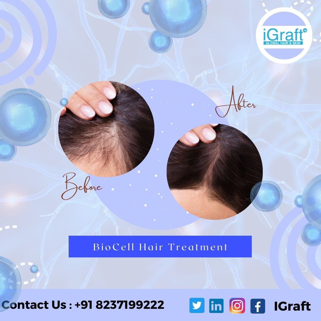 The Most Advanced Technology for Hair Transplantation - iGraft Global ...